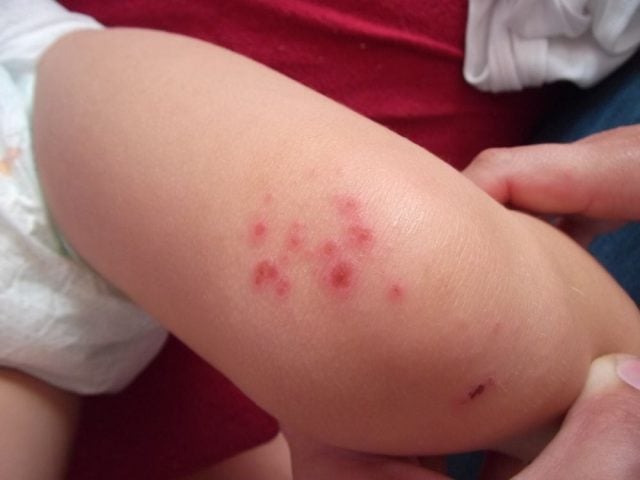 17 Most Common Types of Baby Rashes (With Pictures)